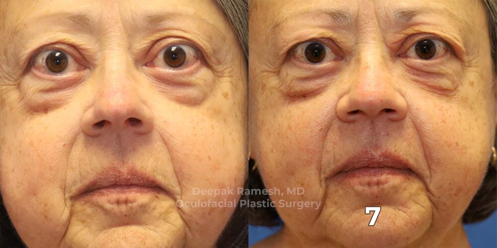 Tepezza - Center for Eye and Facial Plastic Surgery