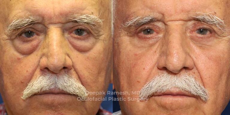 Male Surgery - Center for Eye and Facial Plastic Surgery