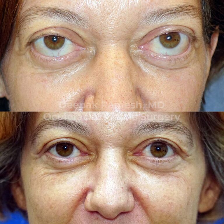 Orbital Decompression - Center for Eye and Facial Plastic Surgery