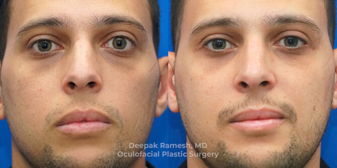 Orbital Decompression - Center for Eye and Facial Plastic Surgery