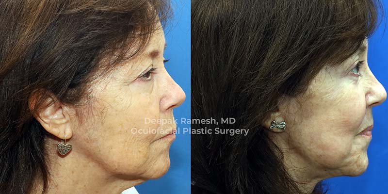 Fat Transfer in Somerset County, New Jersey | Center for Eye & Facial ...