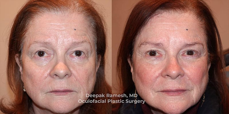 Fat Transfer in Somerset County, New Jersey | Center for Eye & Facial ...