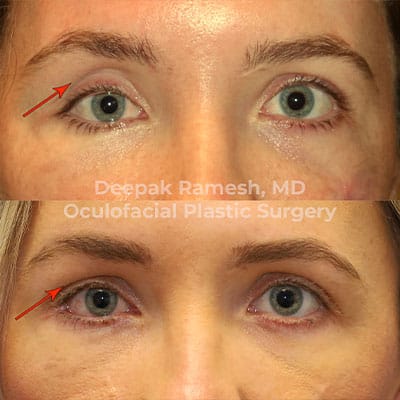 Fat Transfer in Somerset County, New Jersey | Center for Eye & Facial ...