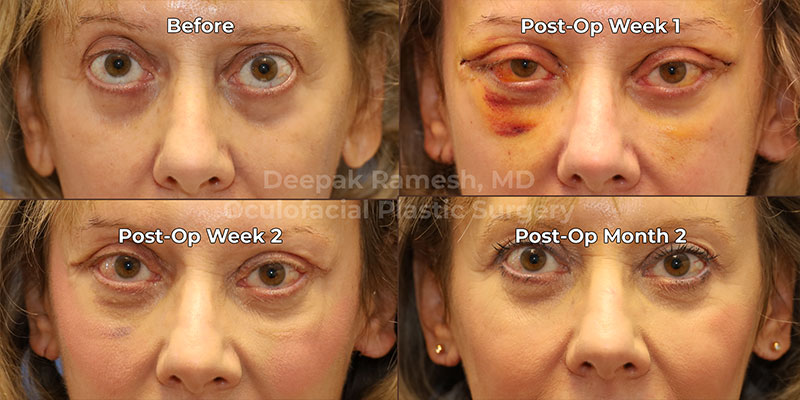 Fat Transfer in Somerset County, New Jersey | Center for Eye & Facial ...