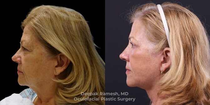 Face & Neck Surgery - Center for Eye and Facial Plastic Surgery