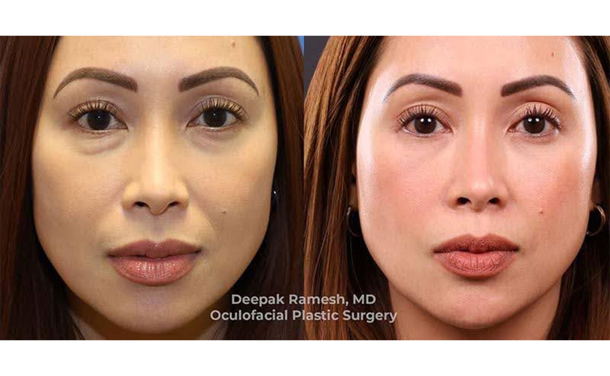 Eyelid Bag Surgery in New Jersey | Dr. Deepak Ramesh