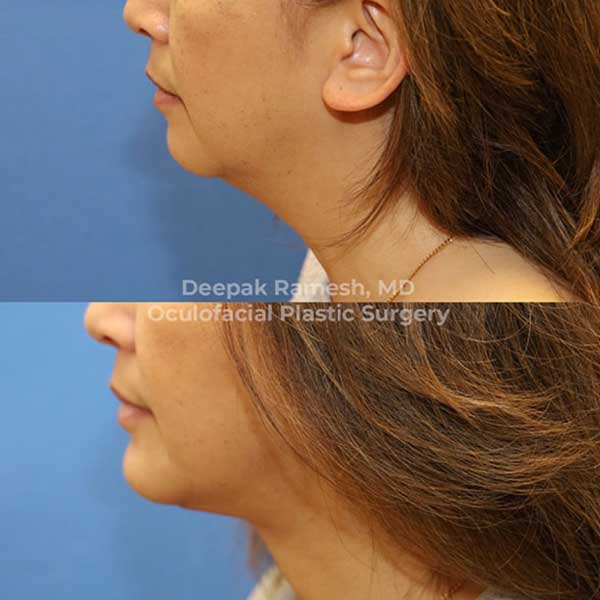 Facial Implants Archives - Center for Eye and Facial Plastic Surgery
