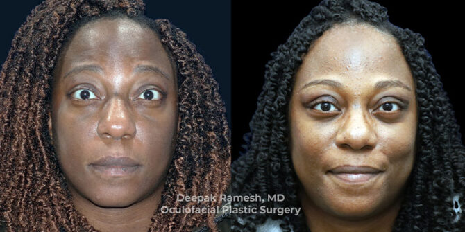 Orbital Decompression - Center for Eye and Facial Plastic Surgery
