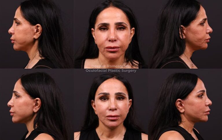 Fat Transfer Revision New Jersey | Dr. Deepak Ramesh