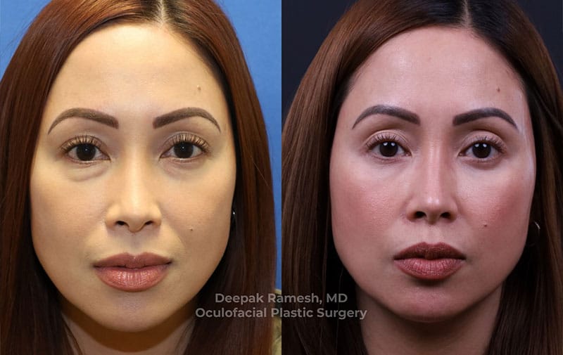 Fat Transfer Revision New Jersey | Dr. Deepak Ramesh