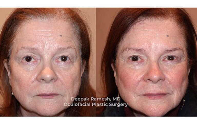 Fat Transfer in Somerset County, New Jersey | Center for Eye & Facial ...