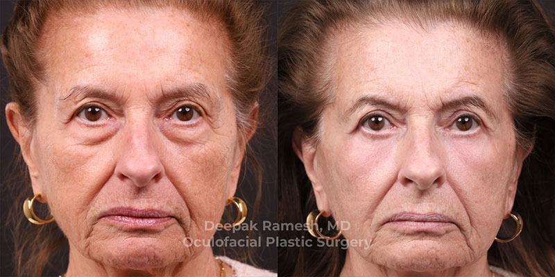 Blepharoplasty & Brow Lift - Center for Eye and Facial Plastic Surgery