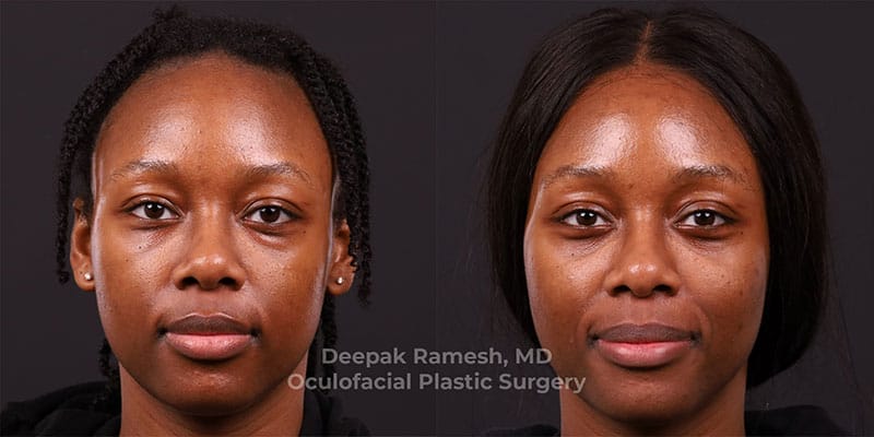 Blepharoplasty & Brow Lift - Center for Eye and Facial Plastic Surgery