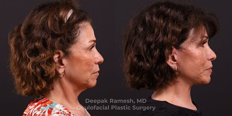 Face & Neck Surgery - Center for Eye and Facial Plastic Surgery