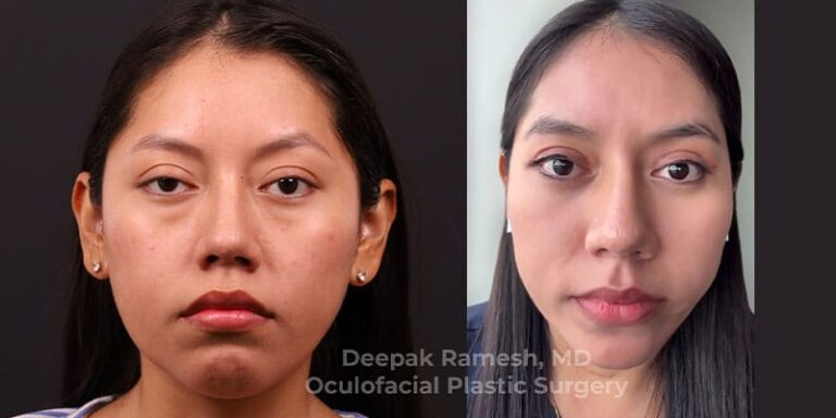 Orbital Decompression - Center for Eye and Facial Plastic Surgery